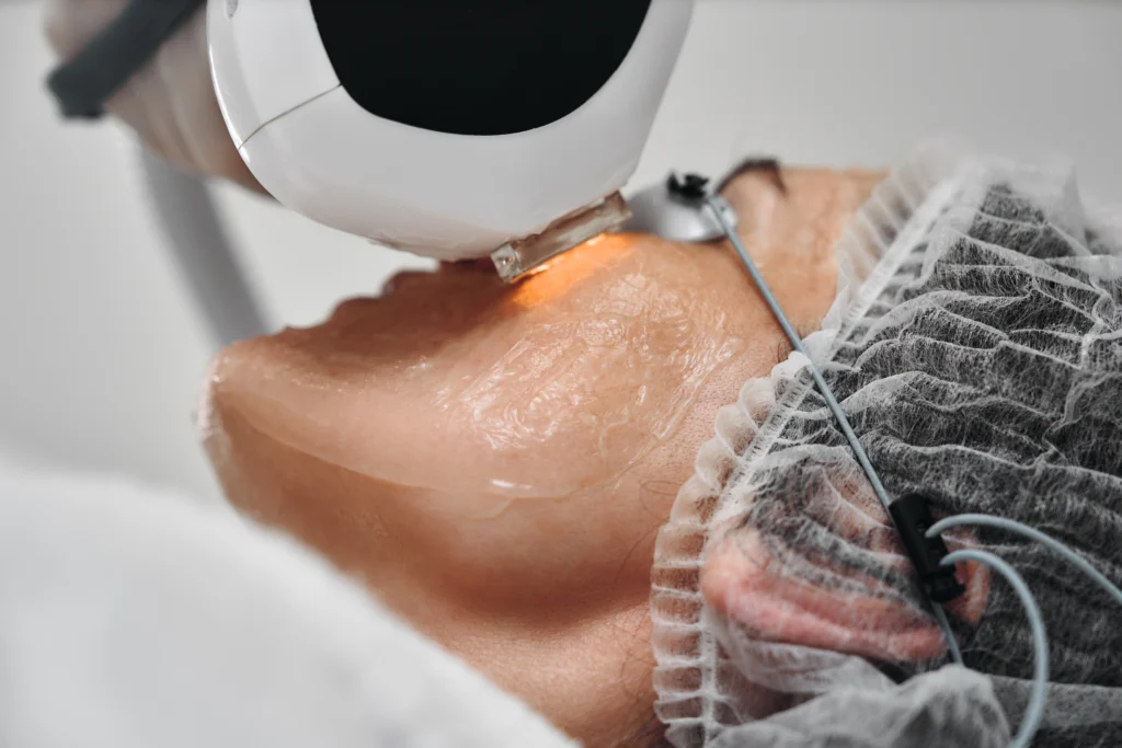 Candela GentleMax Pro®: Revolutionary Laser Treatment Guide